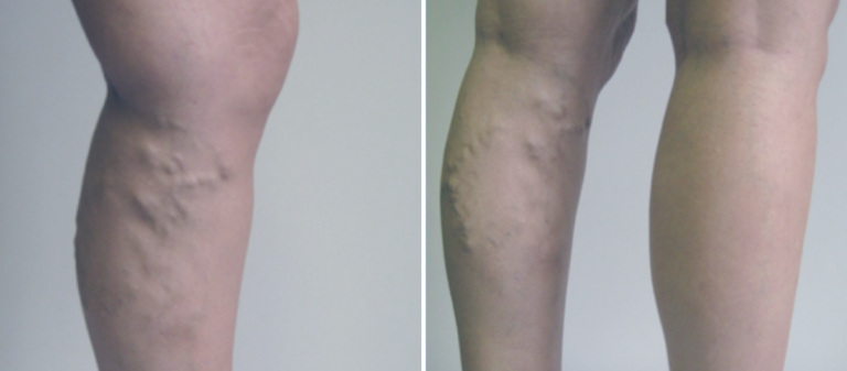Clínica Reina & ReinaINSUFICIENCIA VENOSA CRONICA/VARICES – Clínica ...